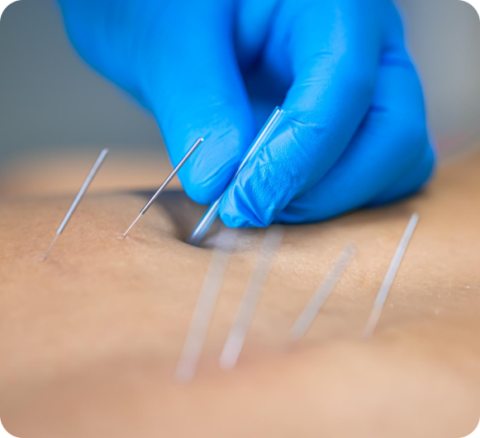 Dry needling & acupuncture - BT Physio